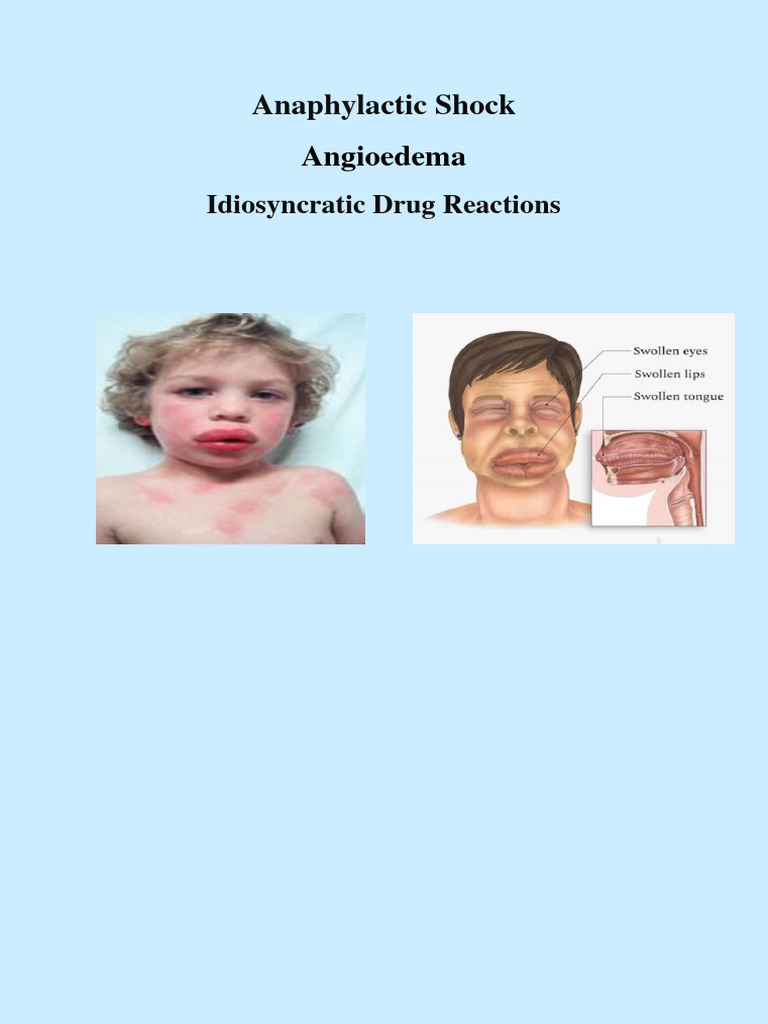 Anaphylactic Shock | PDF | Allergy | Causes Of Death