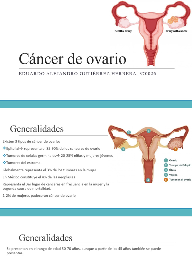 Cancer de Ovario | PDF | Cáncer | Cáncer de ovarios
