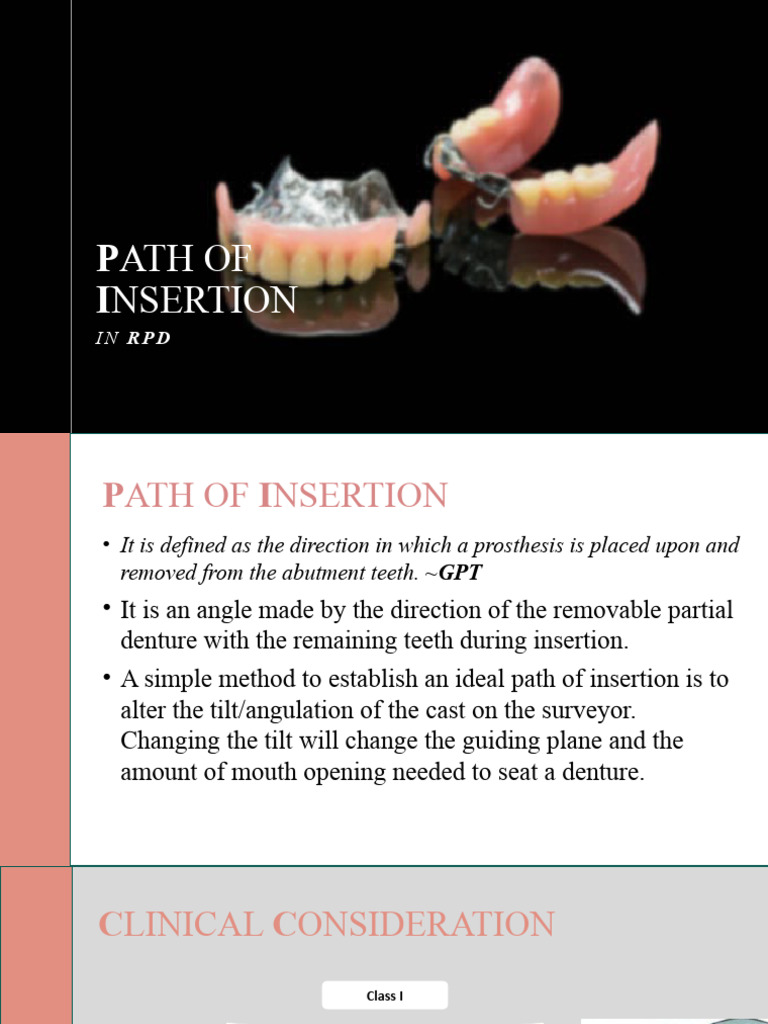 Path of Insertion in RPD | PDF | Dental Anatomy | Dentistry Branches