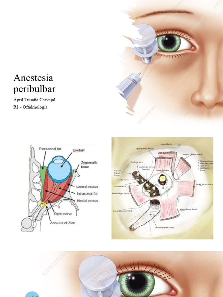 Anestesia Peribulbar | PDF