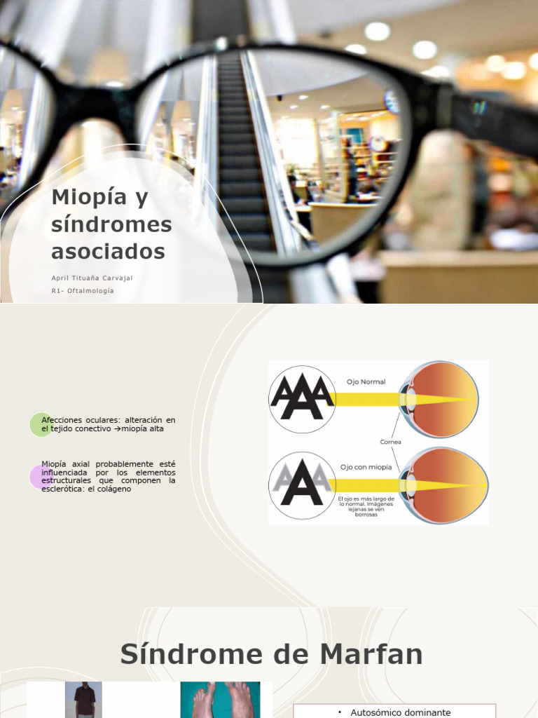 Miopía y Síndromes Asociados | PDF | Miopía | Glaucoma