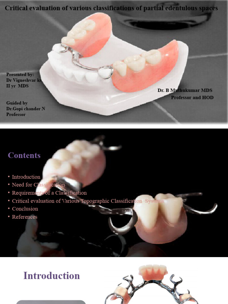 Critical Analysis of RPD Classification System | PDF | Dentistry ...