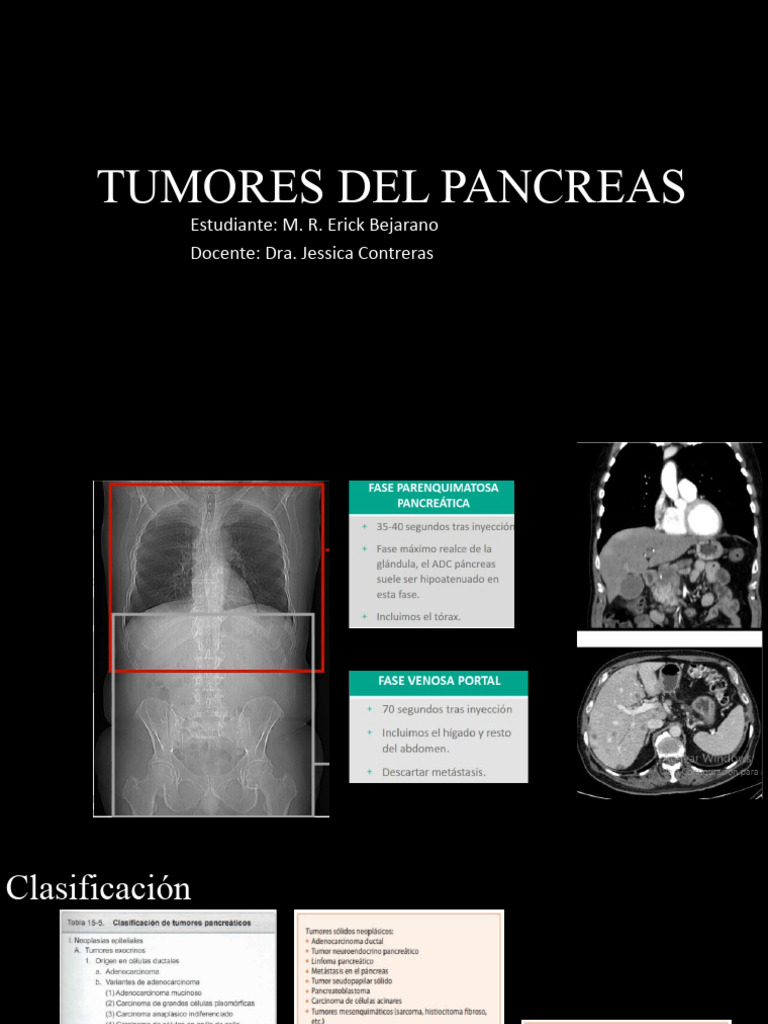 Tumores Del Páncreas | PDF | Páncreas | Cáncer