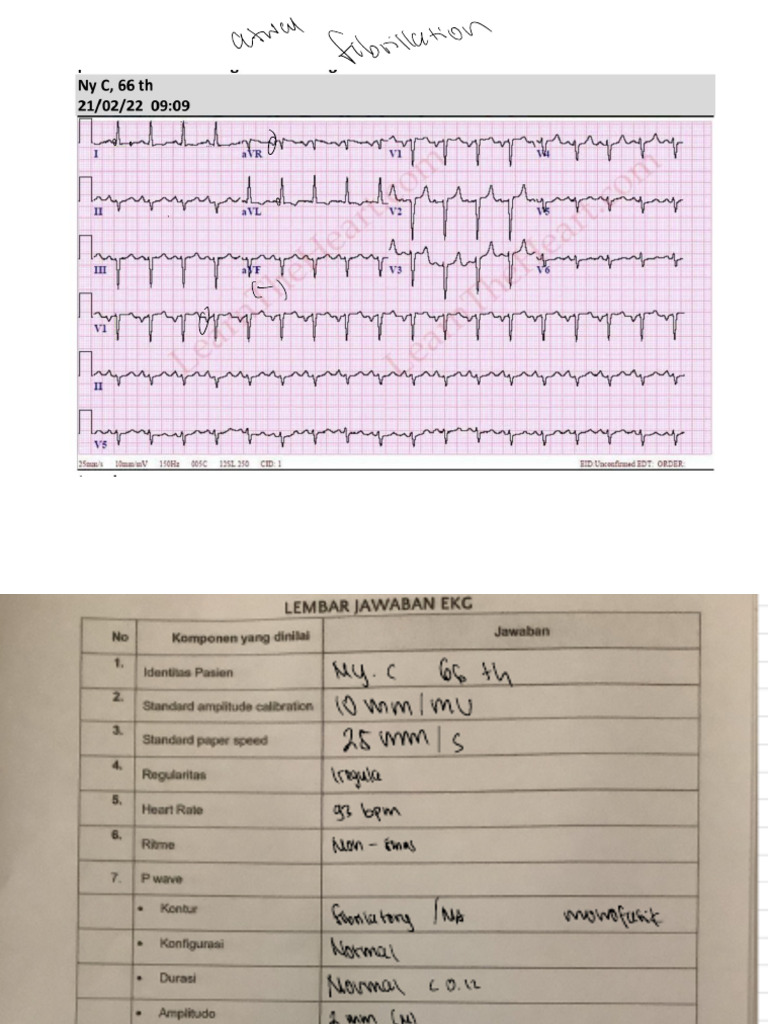 Ekg Latihan Soal | PDF