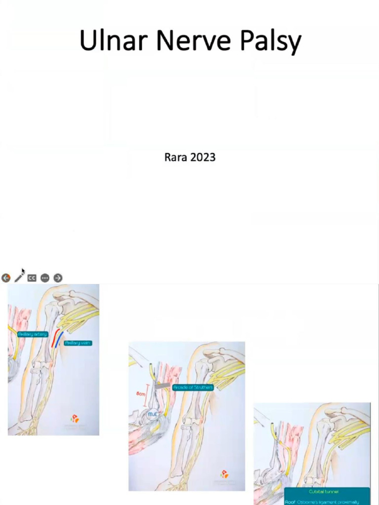 Ulnar Nerve Palsy | PDF