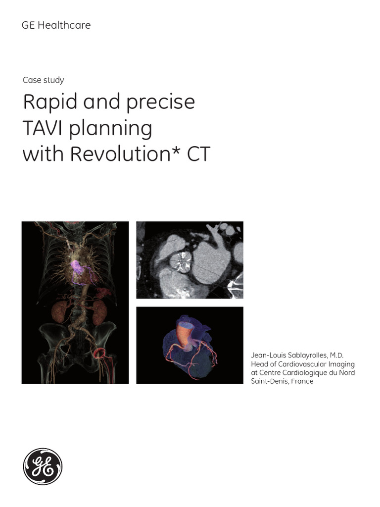 TAVI Planning with Revolution CT | PDF | Ct Scan | Heart