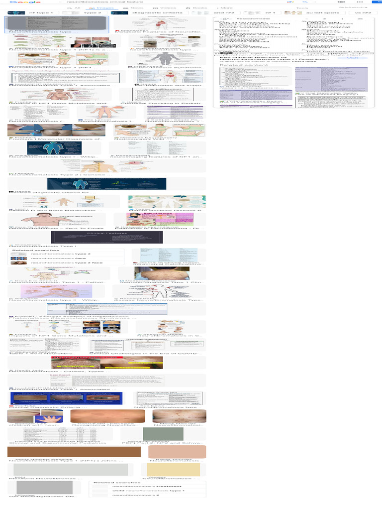 Neurofibromatosis Clinical Feature - Google Search | PDF | Neurology ...