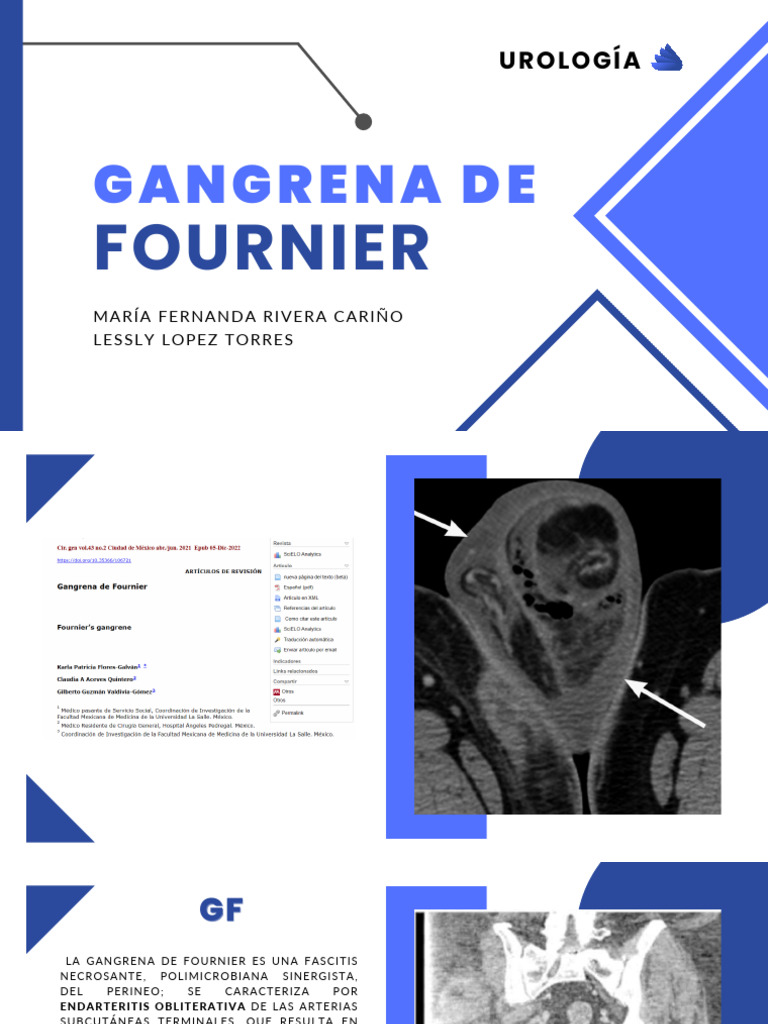 Gangrena de Fournier | PDF | Medicina CLINICA | Necrosis