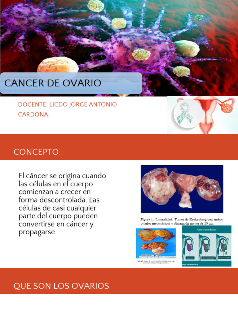 cancer de ovario | PDF | Ovario | Cáncer