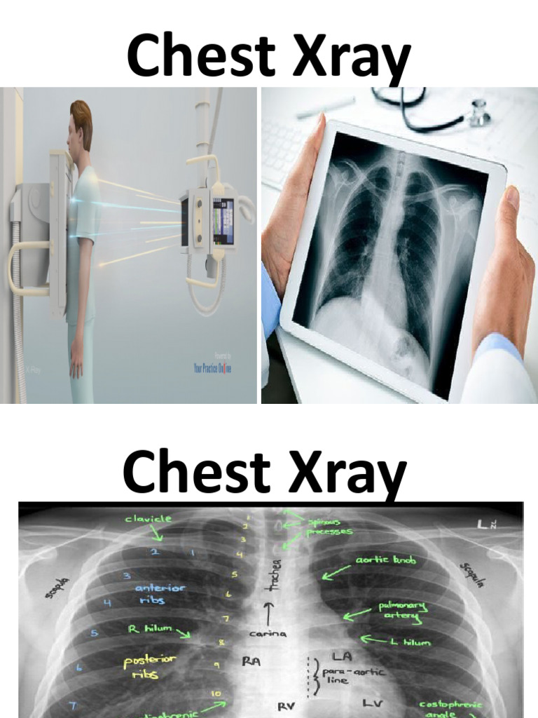 Chest Xray | PDF | Lung | Thorax (Human Anatomy)