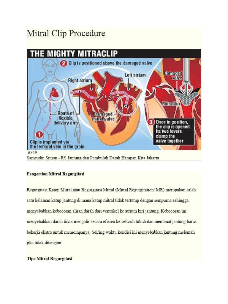 Prosedur Mitral Clip untuk Regurgitasi Mitral | PDF