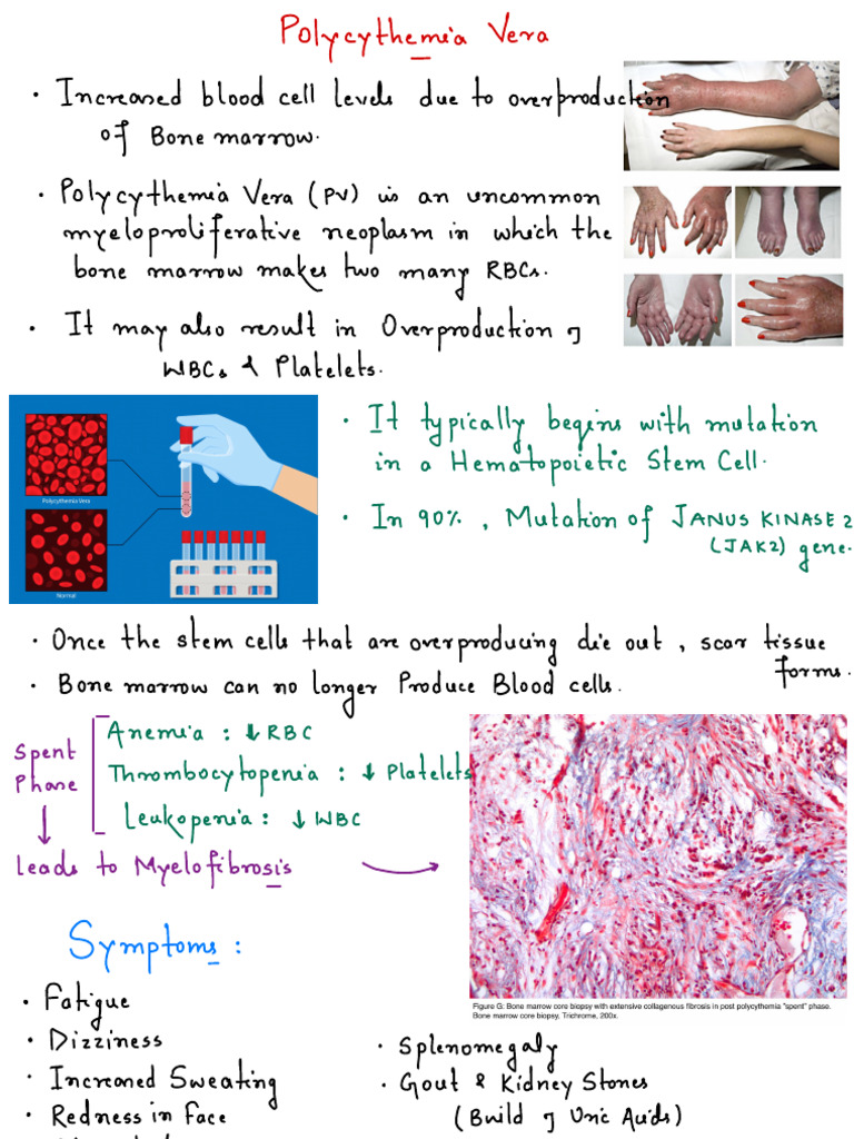 Polycythemia Vera | PDF | Bone Marrow | Hematology