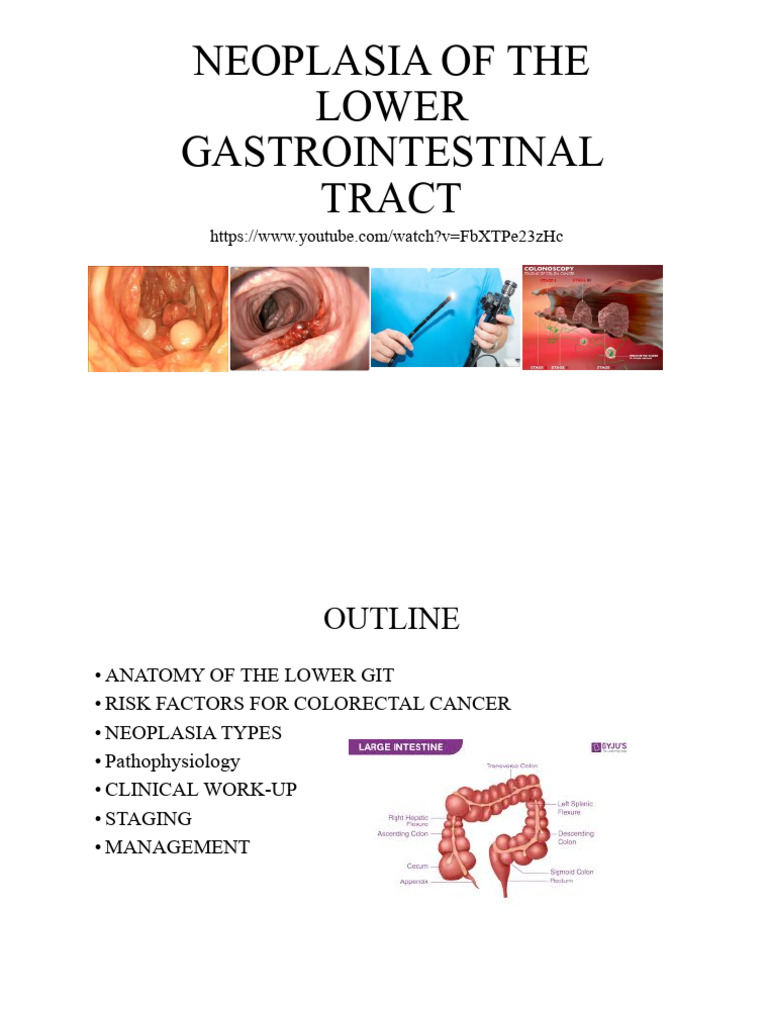 Neoplasia of The Lower Git | PDF | Colorectal Cancer | Cancer