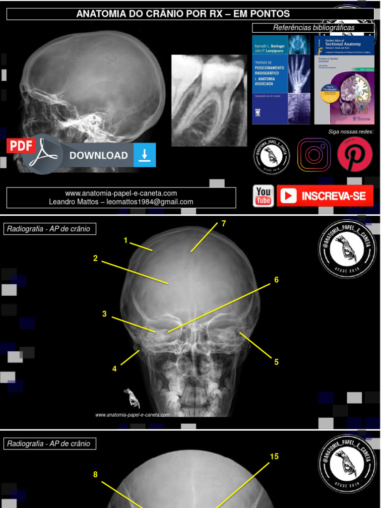 Anatomia Radiológica Do Crânio Leandro Mattos | PDF