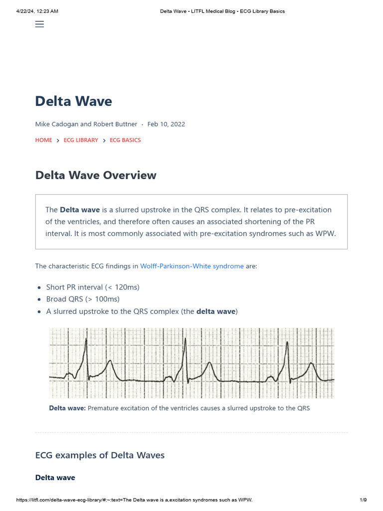 Delta Wave • LITFL Medical Blog • ECG Library Basics | PDF | Cardiac Electrophysiology ...