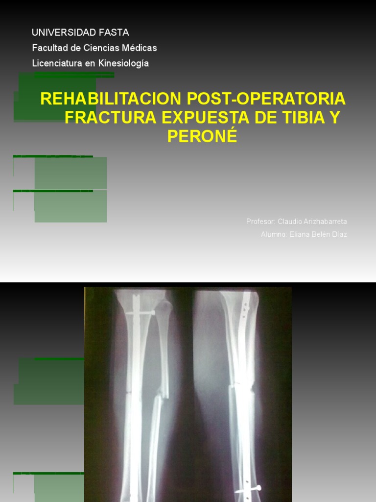 FX Exp. Tibia y Perone | PDF