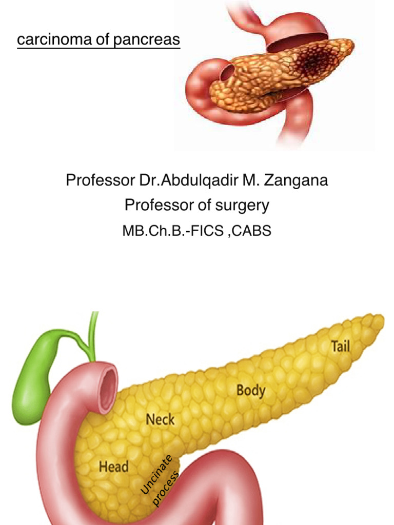ca pancreas 44444 | PDF | Pancreatic Cancer | Pancreas