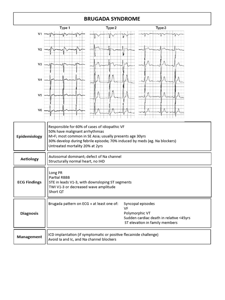 Brugada Syndrome | PDF
