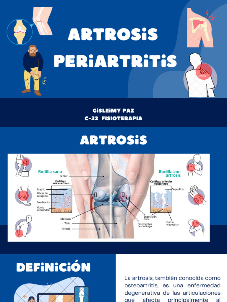 Artrosis-Periartritis Exposición | Descargar gratis PDF | Osteoartritis ...