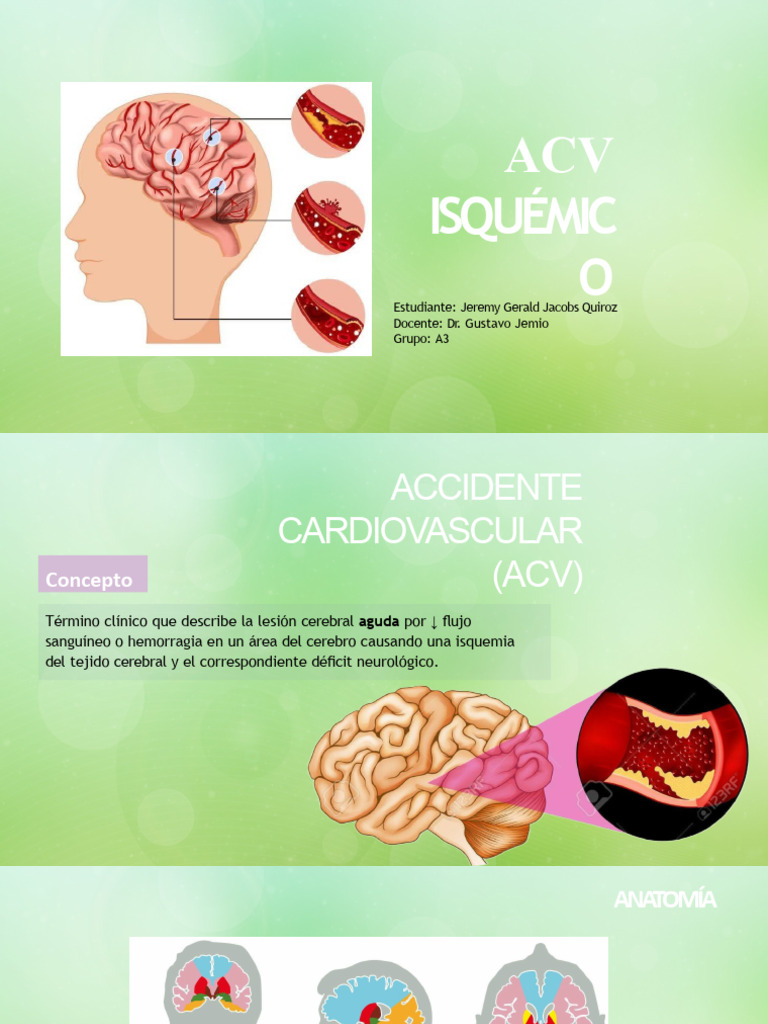 Factores y Clínica del ACV Isquémico | PDF | Carrera | Isquemia