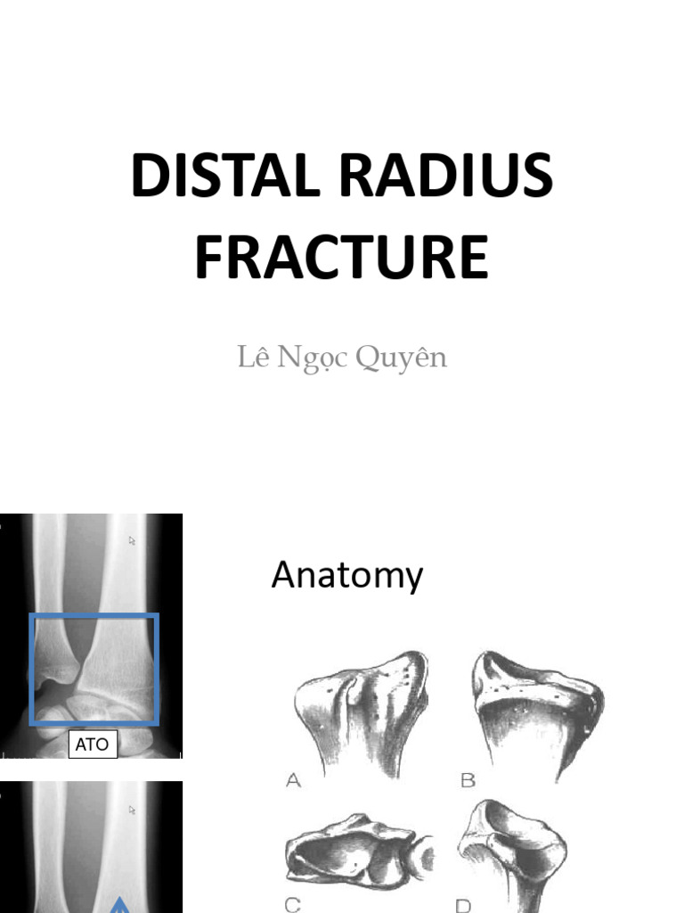Distal Radial Fracture | PDF | Musculoskeletal Disorders | Clinical ...