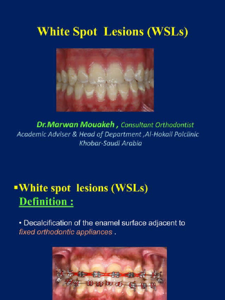 White Spot Lesions | PDF