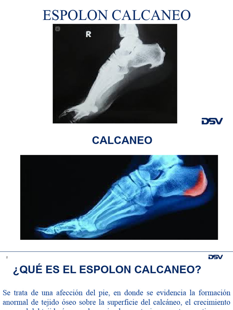 Espolón Calcáneo: Causas y Tratamientos | PDF | Pie | Gota