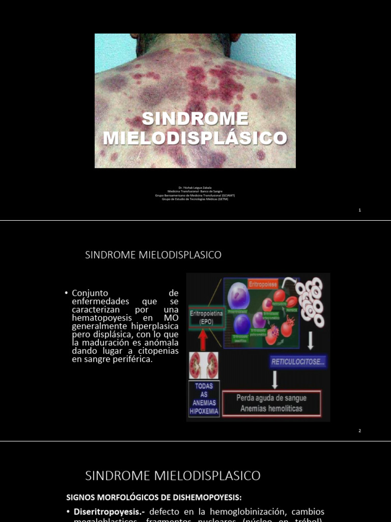 Síndrome Mielodisplásico y Anemia Refractaria | PDF | Anemia | Hematología