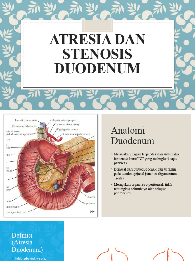 Atresia Dan Stenosis Duodenum | PDF