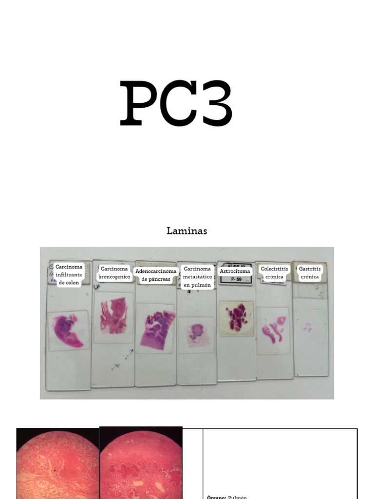 Muestra Histológica para Patologia PC3 | Descargar gratis PDF | Neoplasias | Piel