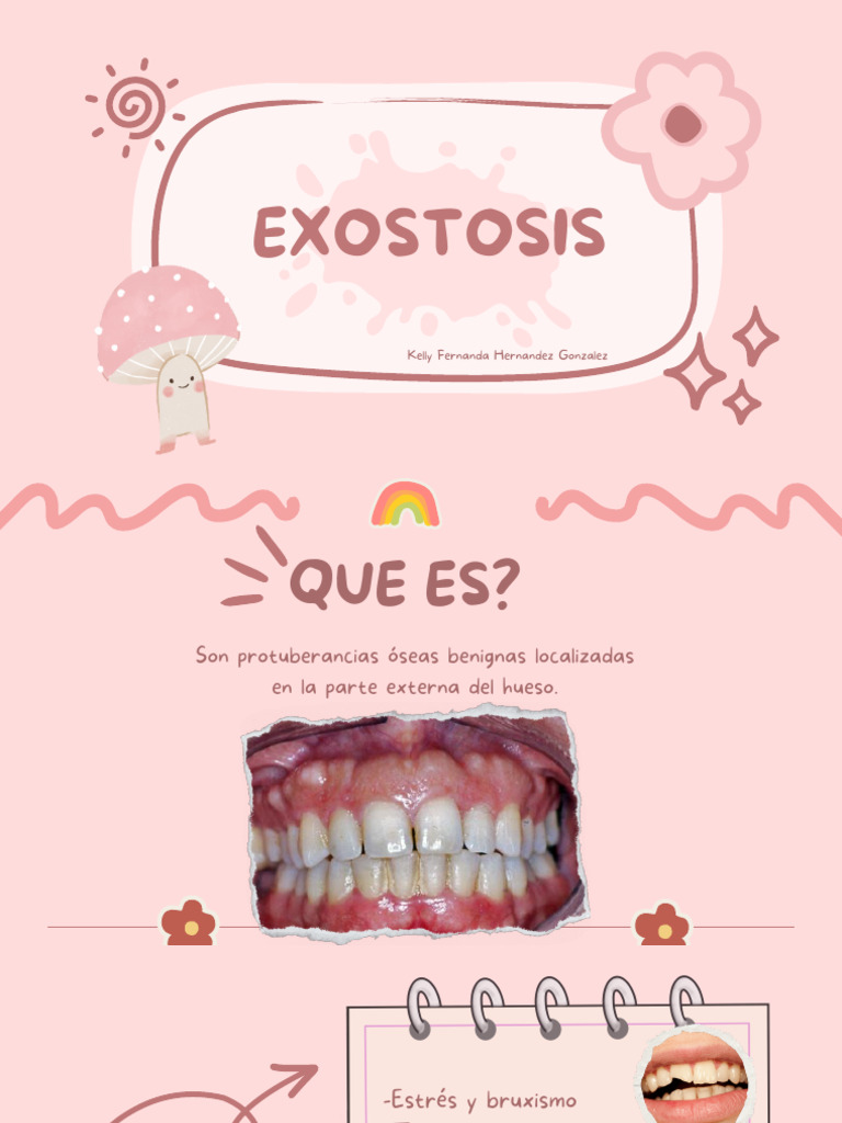 Exostosis-Kelly González | PDF