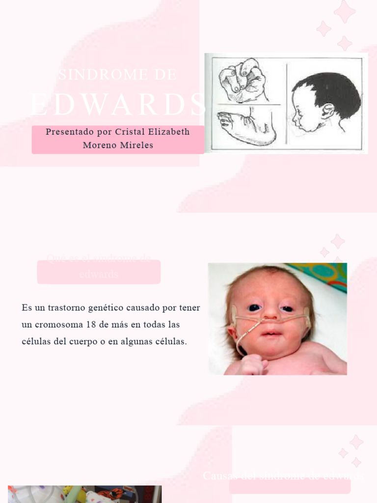 Sindrome de Edward | PDF
