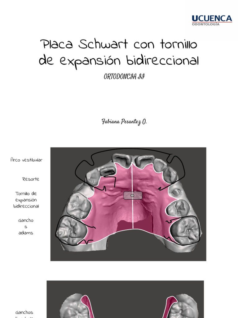 Placa Schwartz con Tornillo Bidireccional | PDF