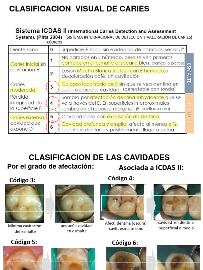 Clasificación ICDAS de Caries Dentales | PDF