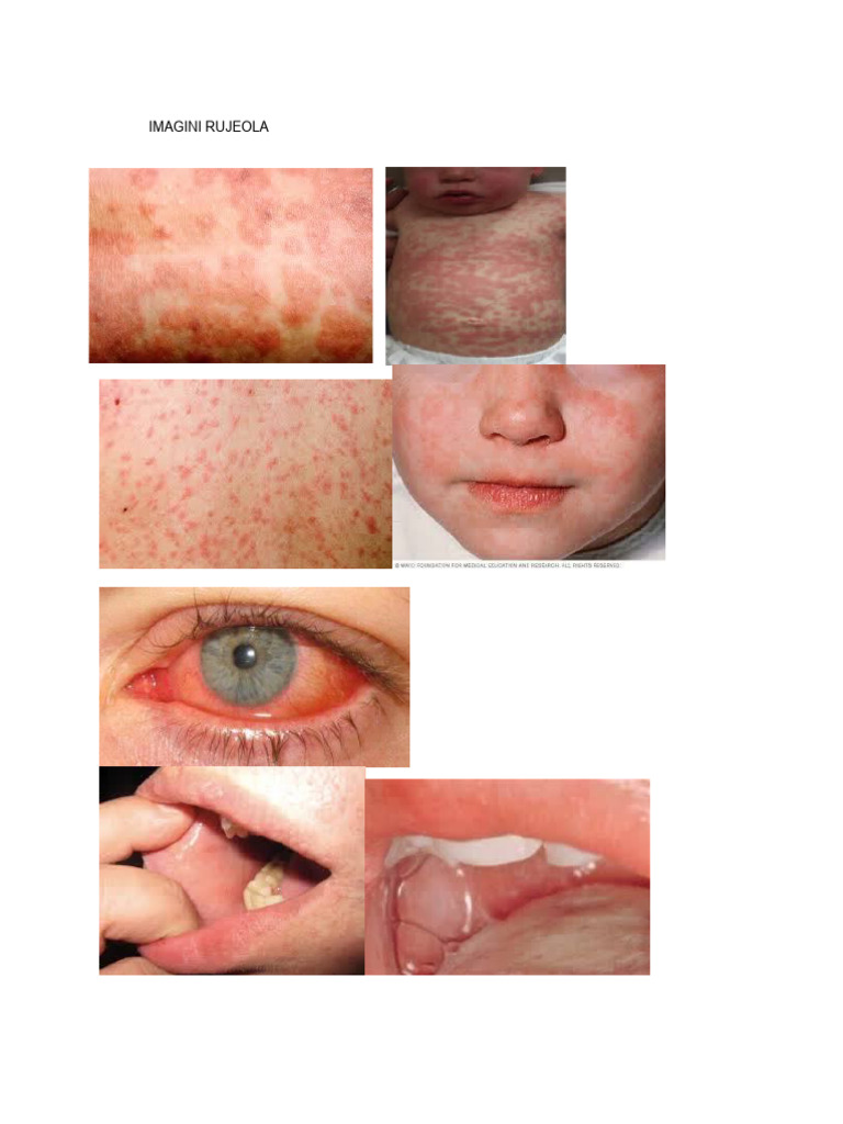 Imagini Rujeola | PDF