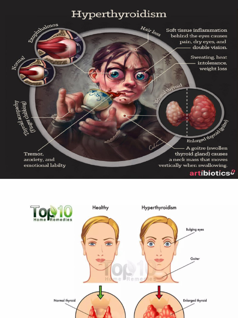 Hyperthyroid Is M | PDF
