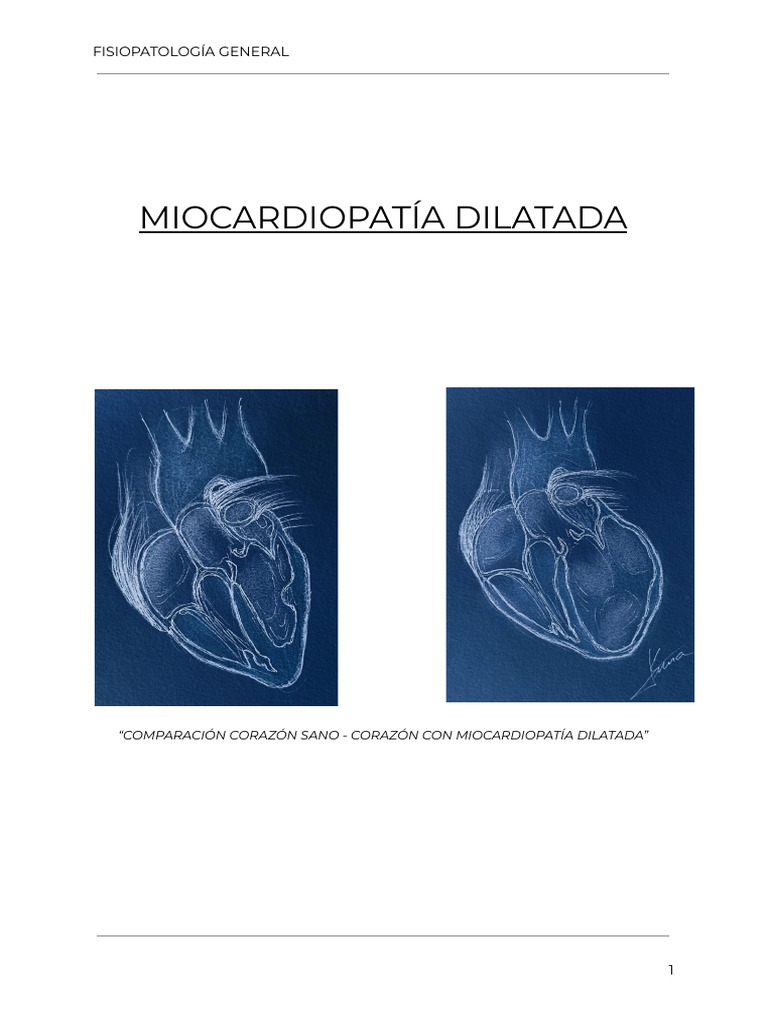 Miocardiopatía Dilatada | PDF | Insuficiencia cardíaca | Enfermedades cardiovasculares