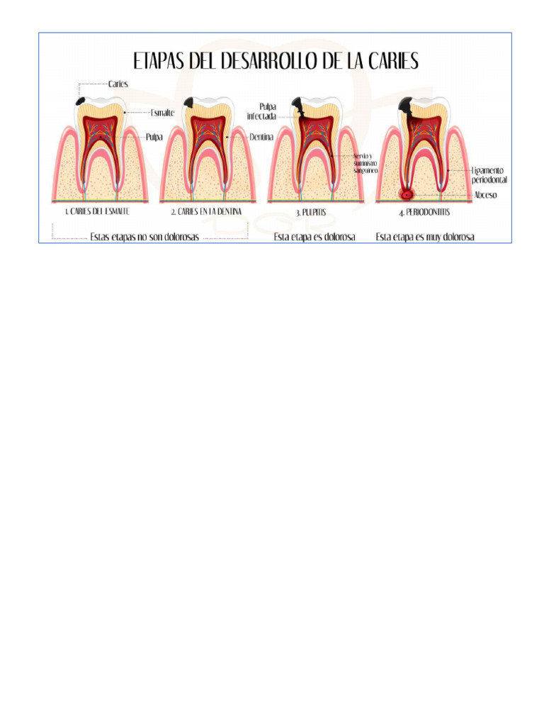 Proceso Carioso | PDF