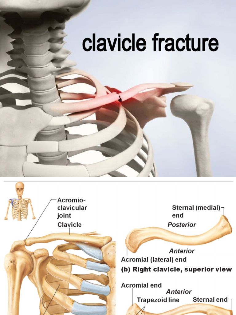 Clavicle Fracture | PDF