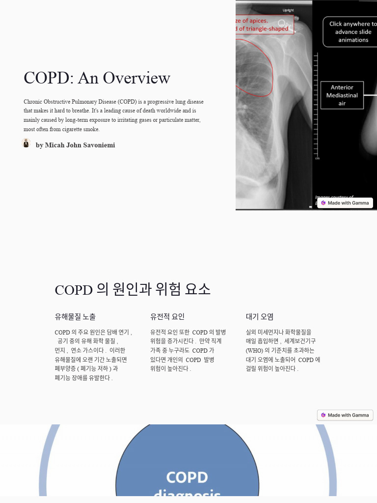 COPD An Overview | PDF