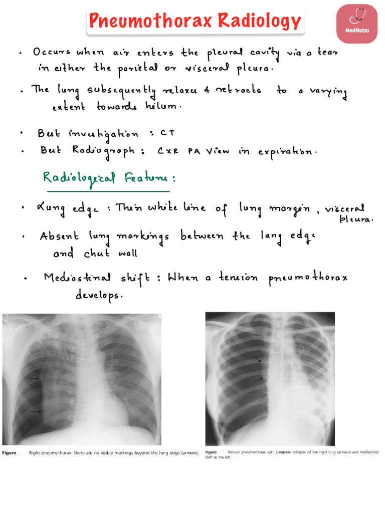 Pneumothorax Radiology | PDF | Lung | Thorax (Human Anatomy)