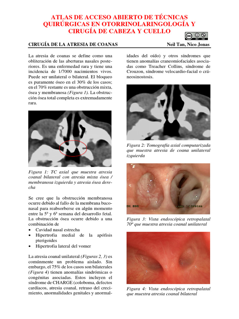 Cirugía de La Atresia de Coanas | PDF | Endoscopia | Medicina CLINICA
