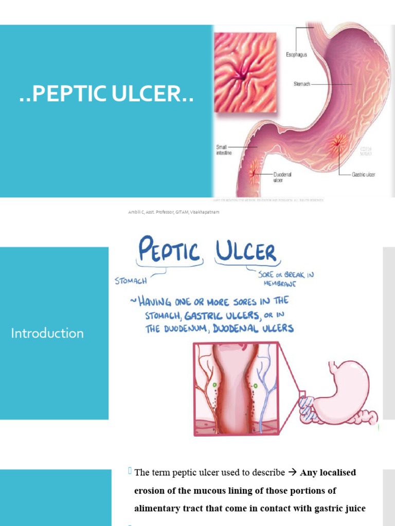 Peptic Ulcer | PDF | Stomach | Digestive System