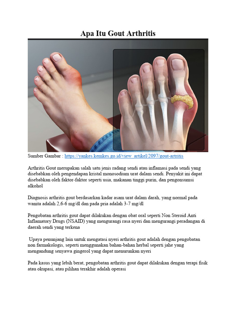 Gout Arthritis: Penyebab dan Pengobatan | PDF