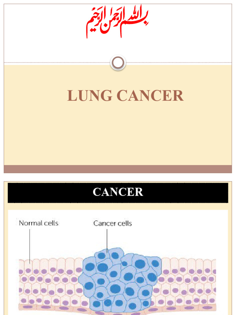 Lung Cancer | Download Free PDF | Cancer | Lung Cancer