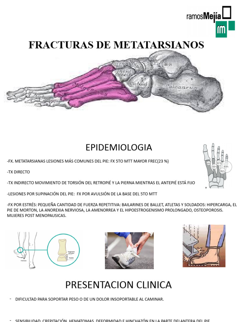 Fracturas de Metatarsianos: Epidemiología y Tratamiento | PDF | Pie ...