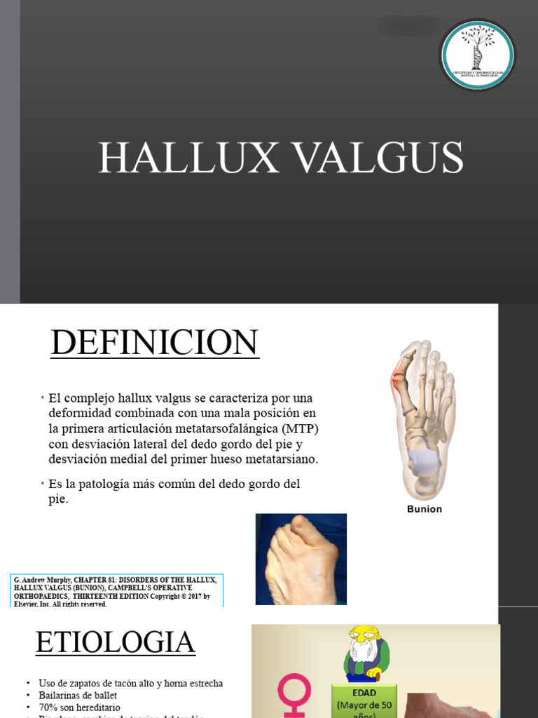 Hallux Valgus | Descargar gratis PDF | Dedo del pie | Pie