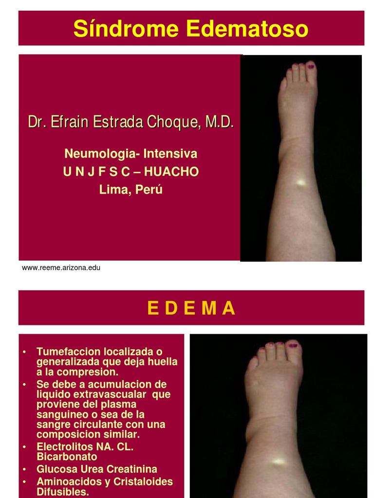 Síndrome Edematoso: Causas y Características | PDF | Edema ...