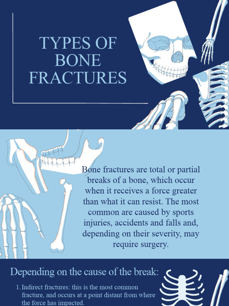 Bone Fractures: Types & Classifications | PDF | Self-Improvement | Wellness