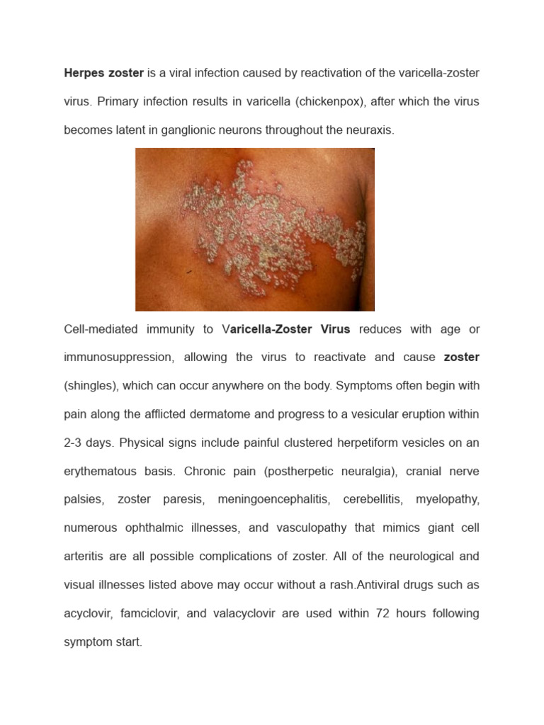 Understanding Herpes Zoster and Its Complications | PDF